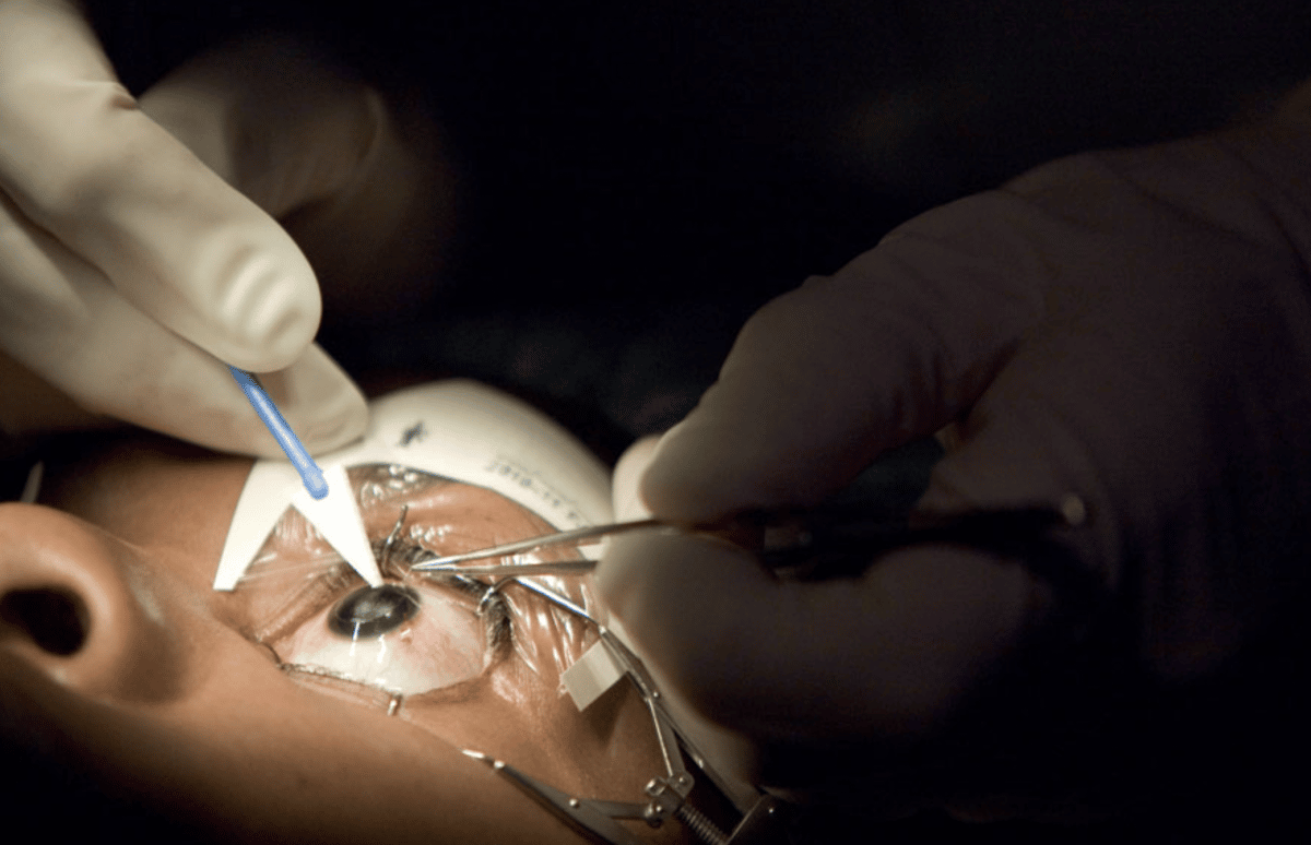 Lasik Surgery What Should You Expect