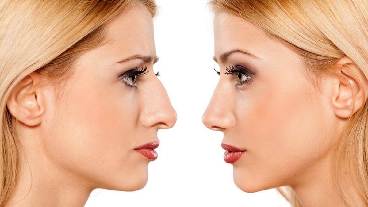 Best Revision Rhinoplasty Surgeons in Turkey?