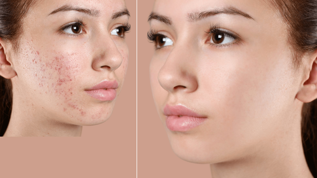 Types of Acne: Causes, Treatments, and Prevention Tips