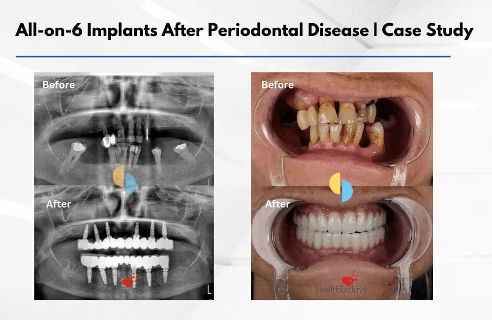 Can You Get Dental Implants After Periodontal Disease? A 2026 All-on-6 ...
